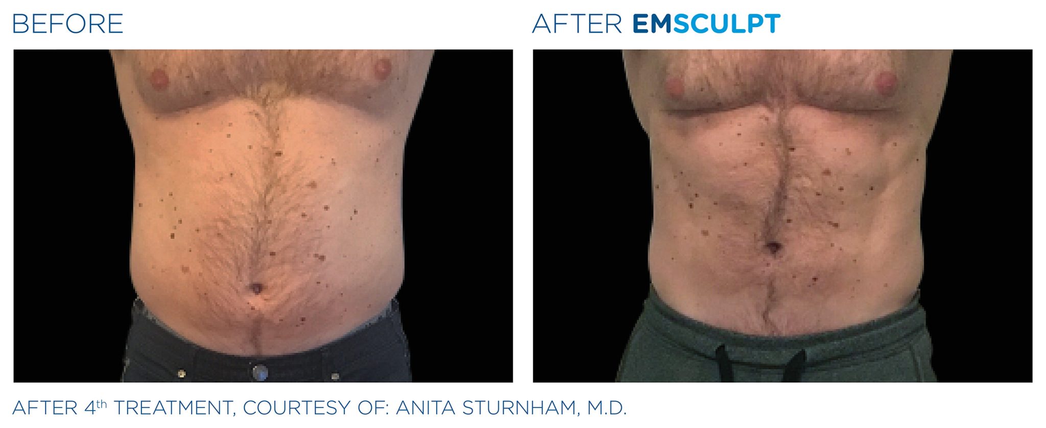 Body Contouring Emsculpt NEO Pittsburgh | Filer Wellness Center